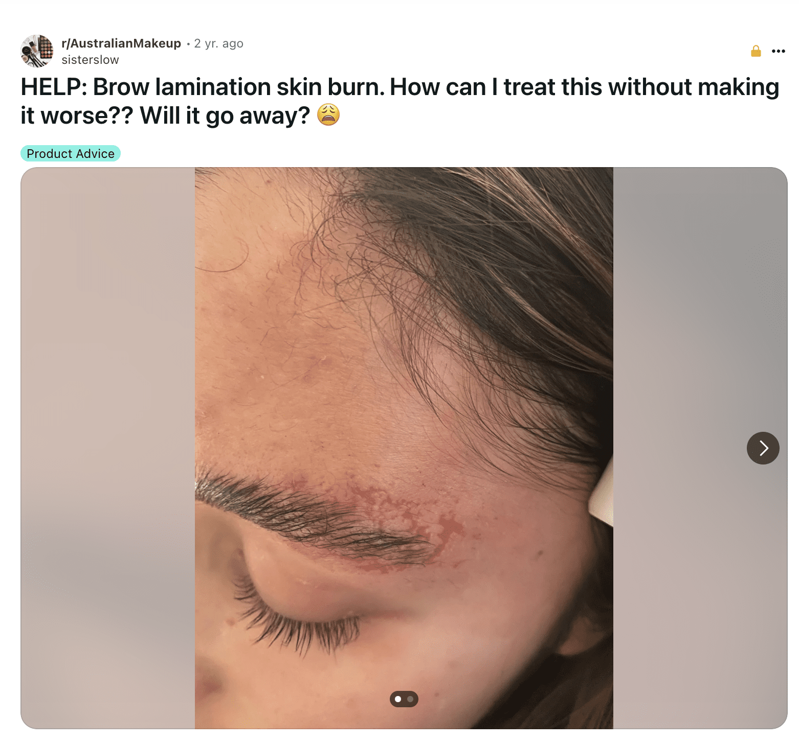 Brow Lamination Gone Wrong: How to Spot and Fix a Bad Eyebrow Lamination